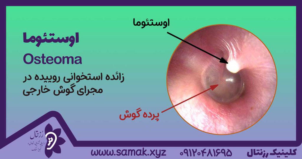 ۲۰ نوع مختلف از بیماری های گوش - کلینیک شنوایی سنجی و سمعک رزنتال